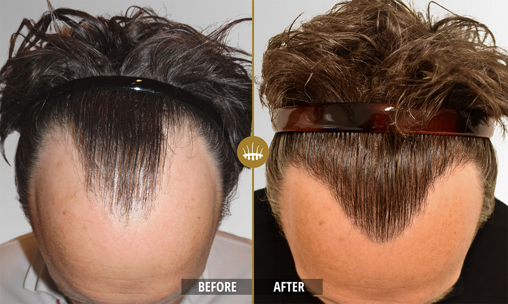 Avant après la greffe capillaire - Hair Science Clinic
