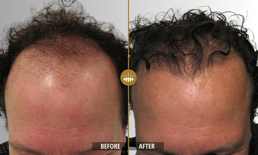 Implant capillaire avant après - Votre greffe de cheveux avec Hasci