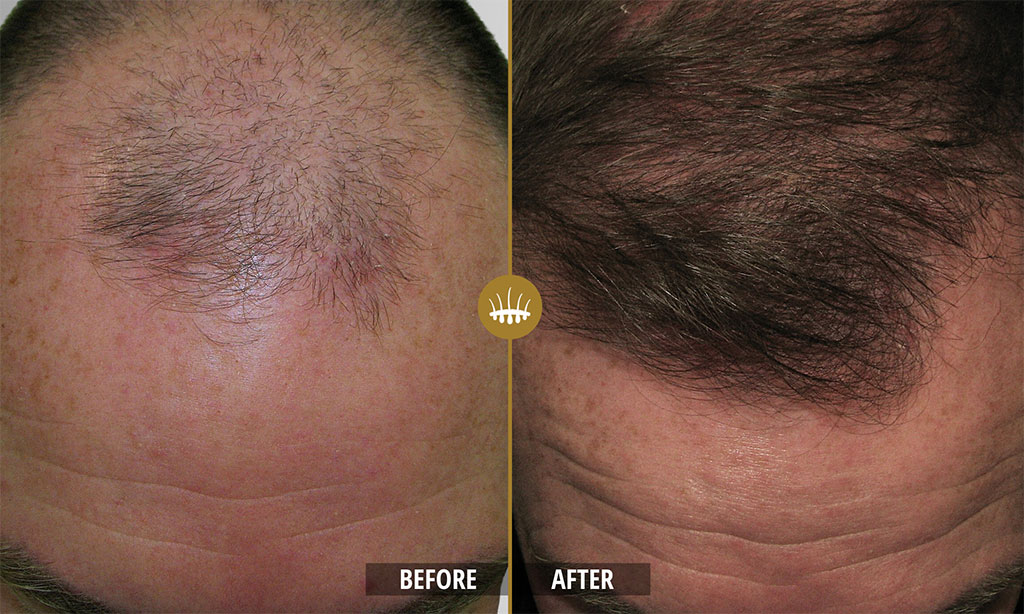 Avant après la greffe capillaire - Hair Science Clinic