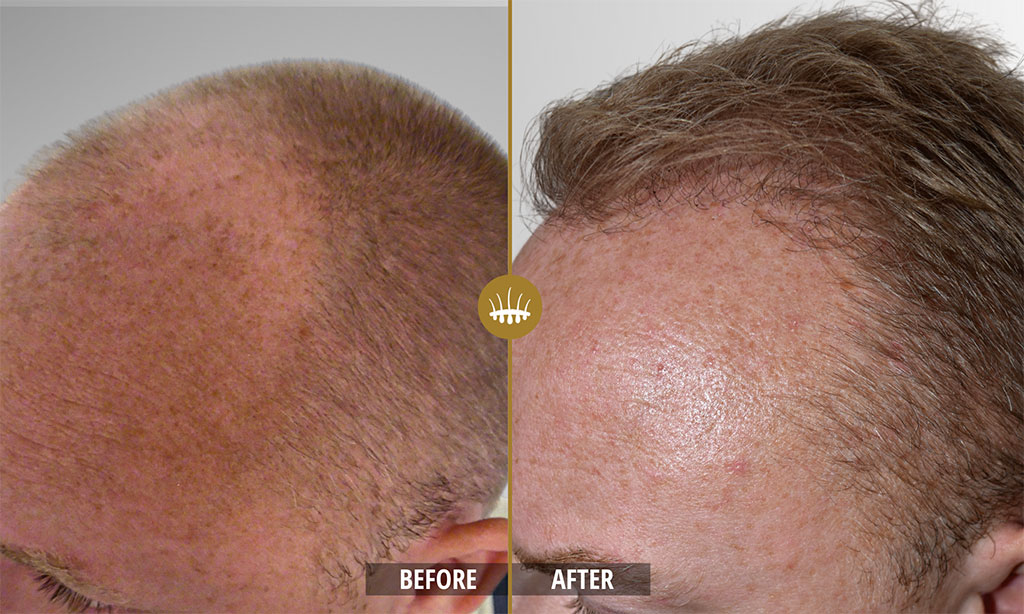 Avant après la greffe capillaire - Hair Science Clinic