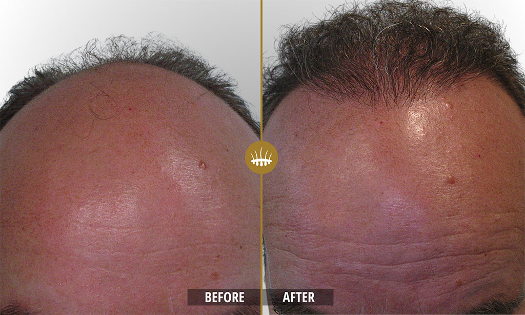 Avant après la greffe capillaire - Hair Science Clinic