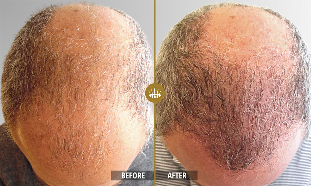 Avant après la greffe capillaire - Hair Science Clinic
