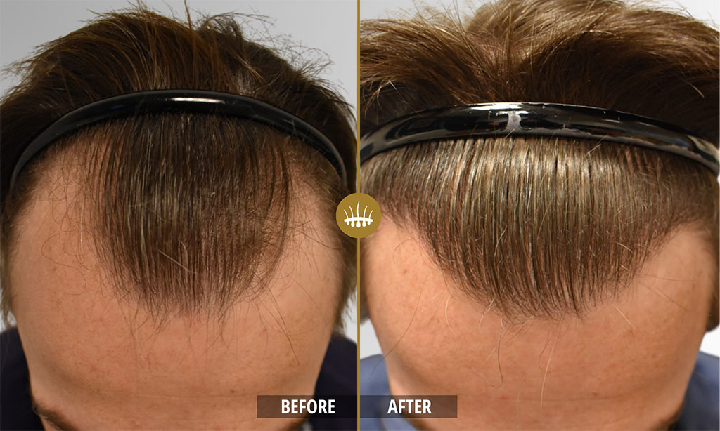 Avant après la greffe capillaire - Hair Science Clinic