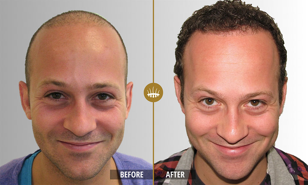 Avant après la greffe capillaire - Hair Science Clinic