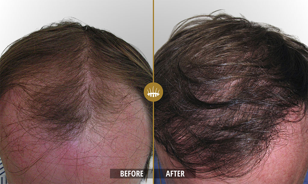 Avant après la greffe capillaire - Hair Science Clinic