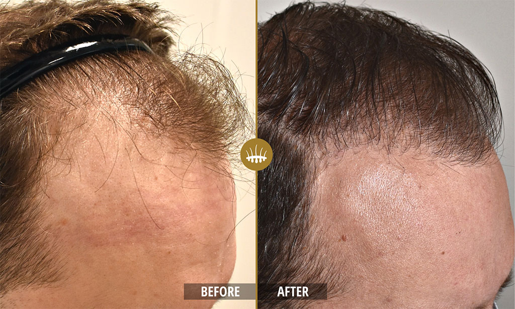 Avant après la greffe capillaire - Hair Science Clinic