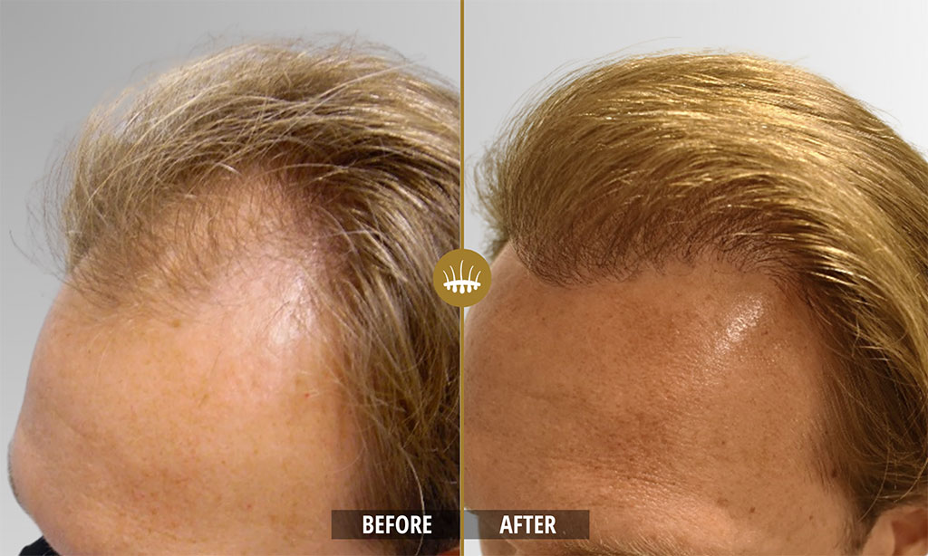 Avant après la greffe capillaire - Hair Science Clinic