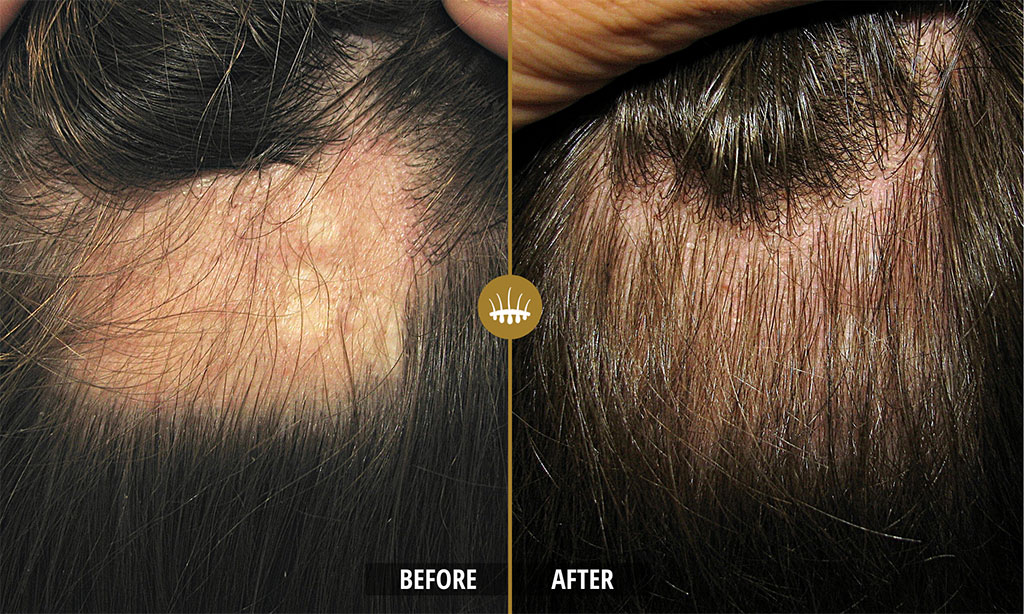 Implant capillaire avant après - Votre greffe de cheveux avec Hasci