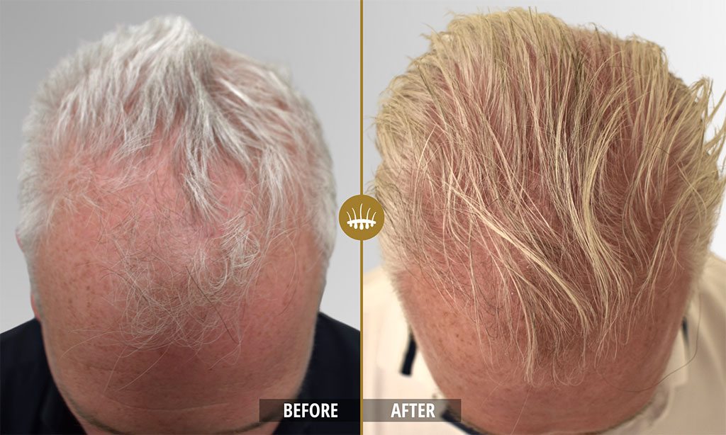 Avant après la greffe capillaire - Hair Science Clinic