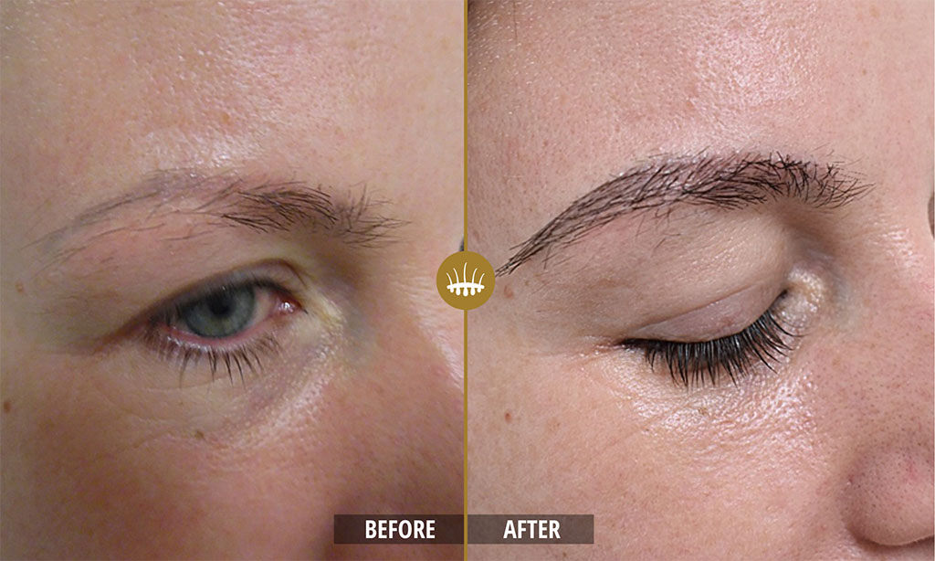 Prix greffe de cheveux - Clinique capillaire Hasci